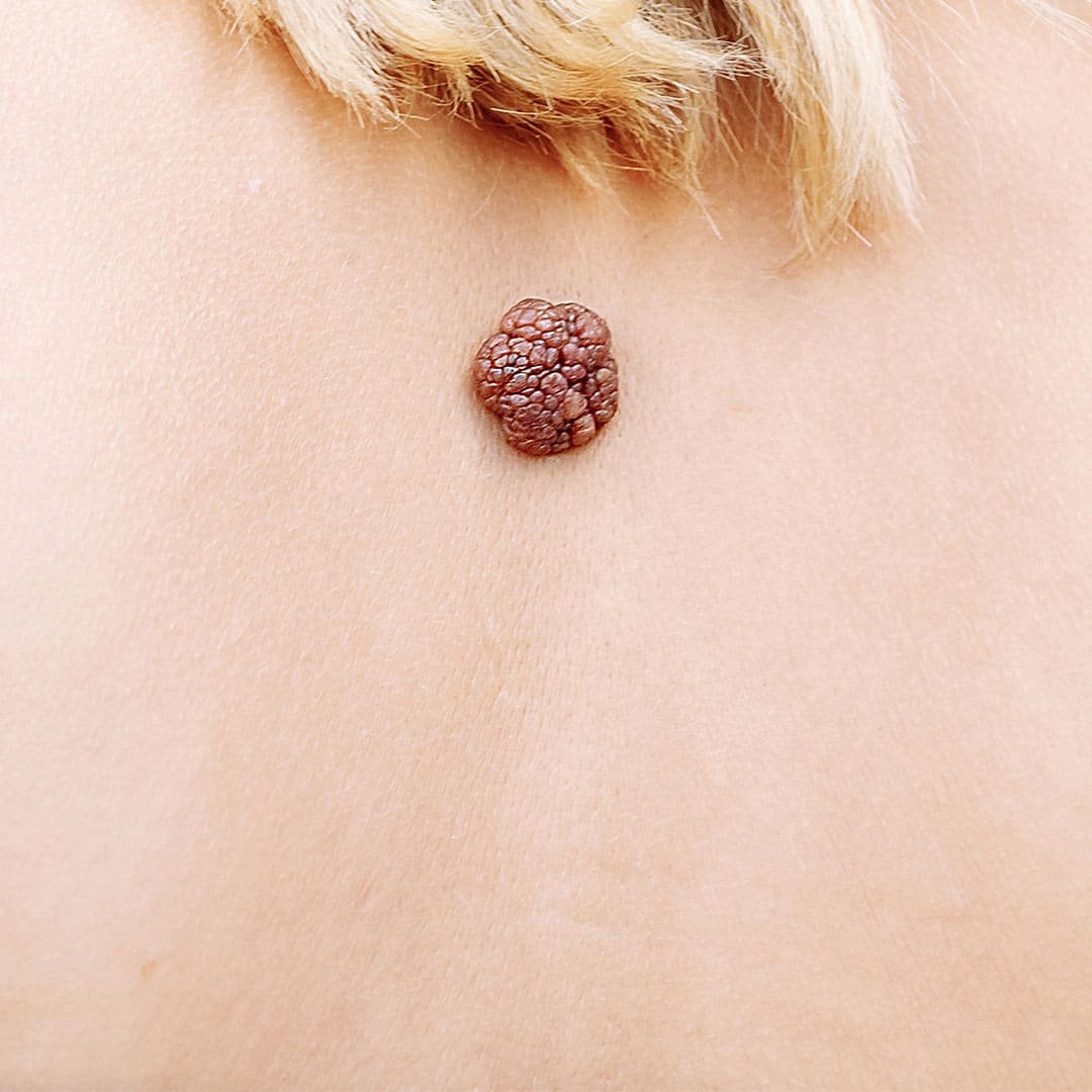 Non-Melanoma Skin Cancer - TKMD